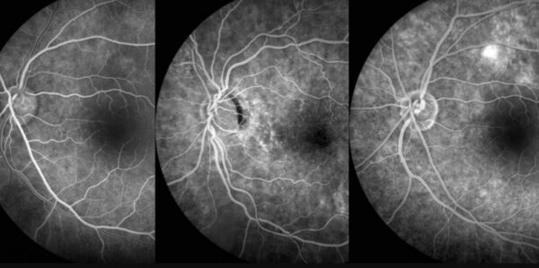 Angiografia ocular: o que é e como funciona – Clínica Oftalmológica ...