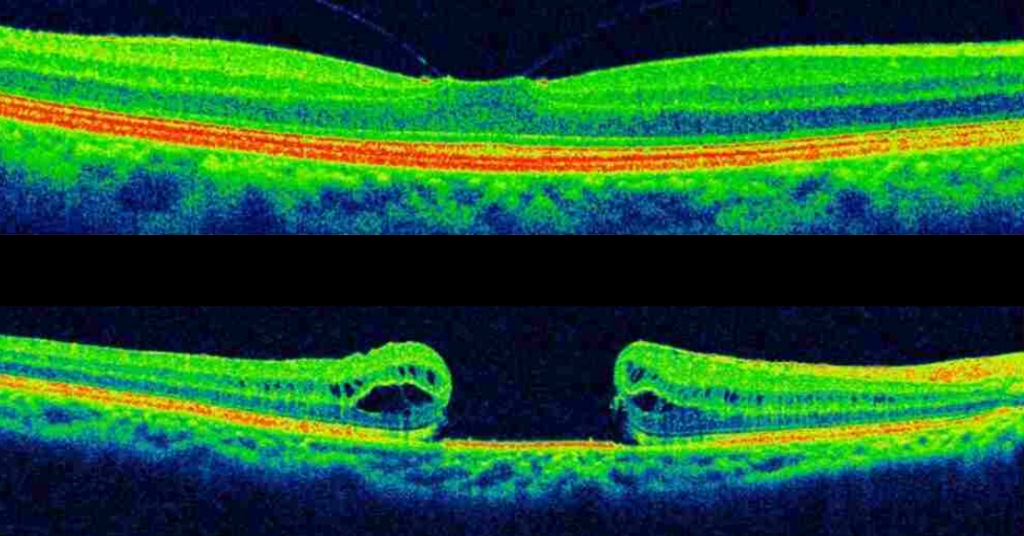 Buraco Macular: o que é, causas, sintomas e tratamento