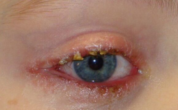 Blefarite: o que é, sintomas, causas tratamento, prevenção – Clínica ...
