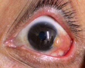 Conjuntiva: o que é, função, principais doenças e irritações – Clínica ...