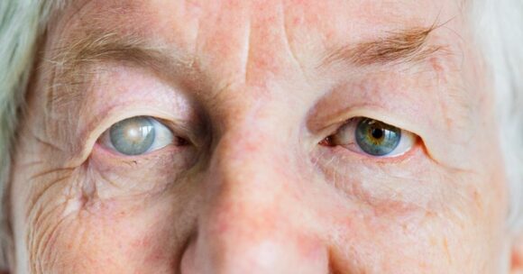 Catarata: o que é, causas da doença, tratamentos e sinais / sintomas