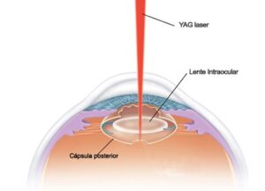 Capsulotomia por laser YAG: o que é? – Clínica Oftalmológica Porto ...